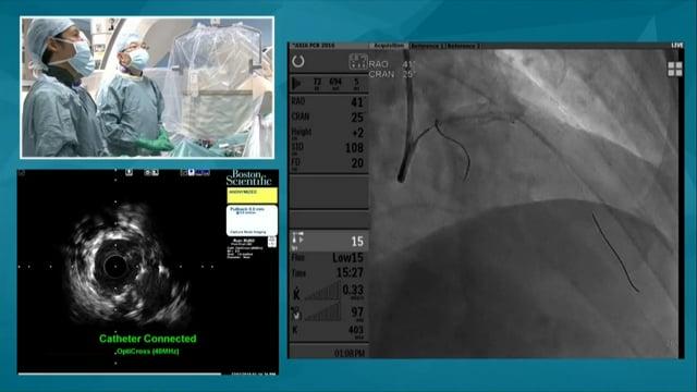 Managing Complex Coronary Interventions with Resolute Onyx (2.0-5.0 ...