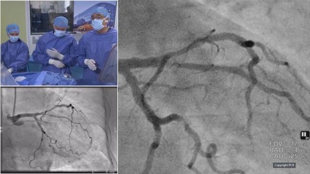 Left main and multivessel disease