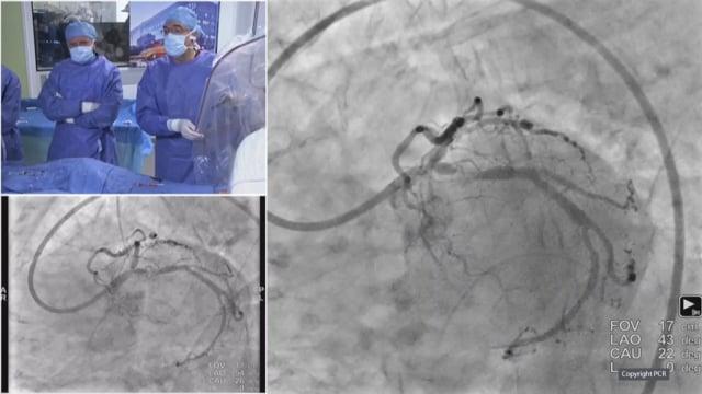 Left main and multivessel disease